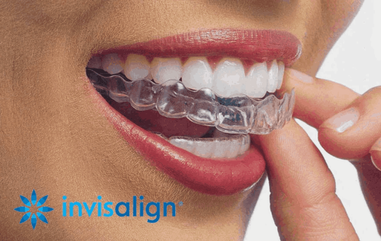 Invisalign Clear Aligner in Malaysia - Dental Space Cheras
