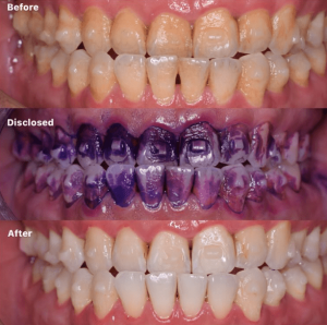 EMS Airflow & Painless Scaling in Cheras - Dental Space